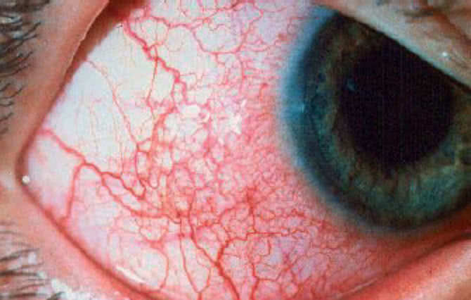 Bindehautentzündung - Dr. med. Andreas Bach und Dr. med. Daniela Buck ...